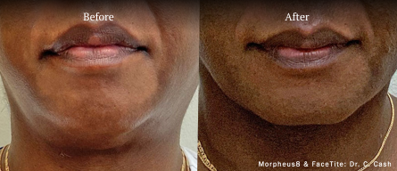 Morpheus 8 Skin Resurfacing Treatment - Dr Queenie Chan