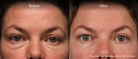 Morpheus 8 Skin Resurfacing Treatment - Dr Queenie Chan