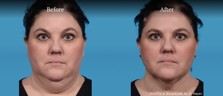 Morpheus 8 Skin Resurfacing Treatment - Dr Queenie Chan