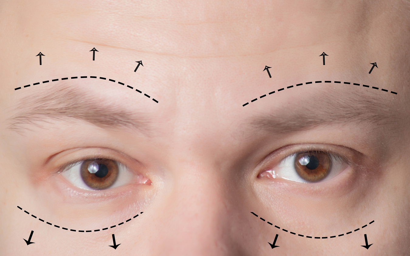 Brow Ptosis Treatment | Surgical & Non-Surgical Brow Lift